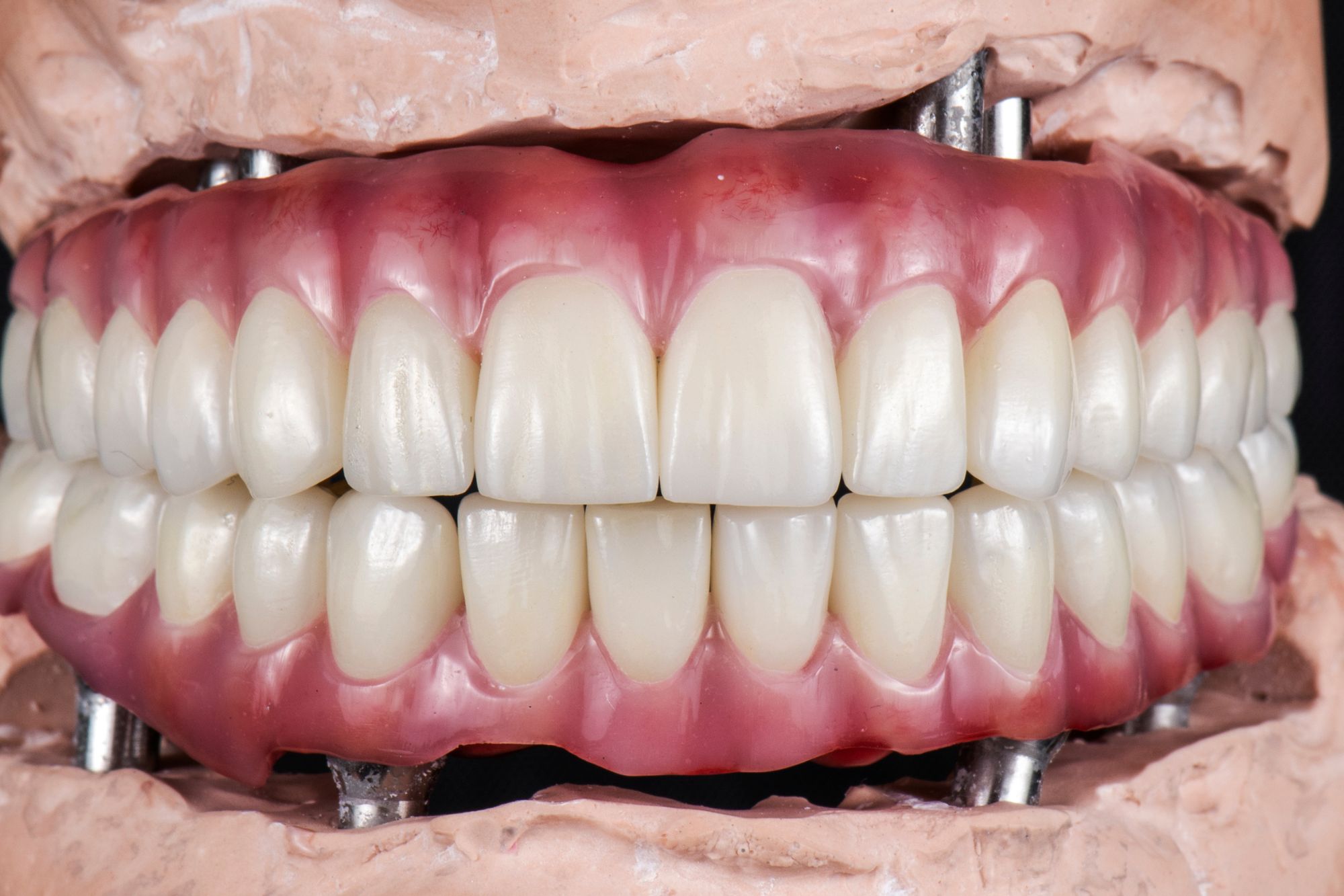 All-on-4 Dental - Guide to Permanent Teeth in a Day